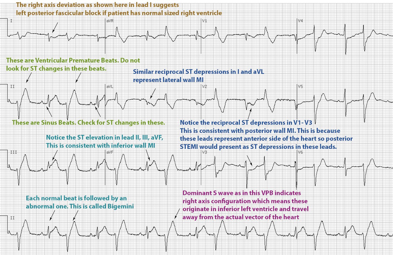 Ventricular Bigeminy Lead Ii