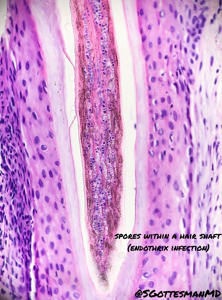 Tinea Capitis Ectothrix