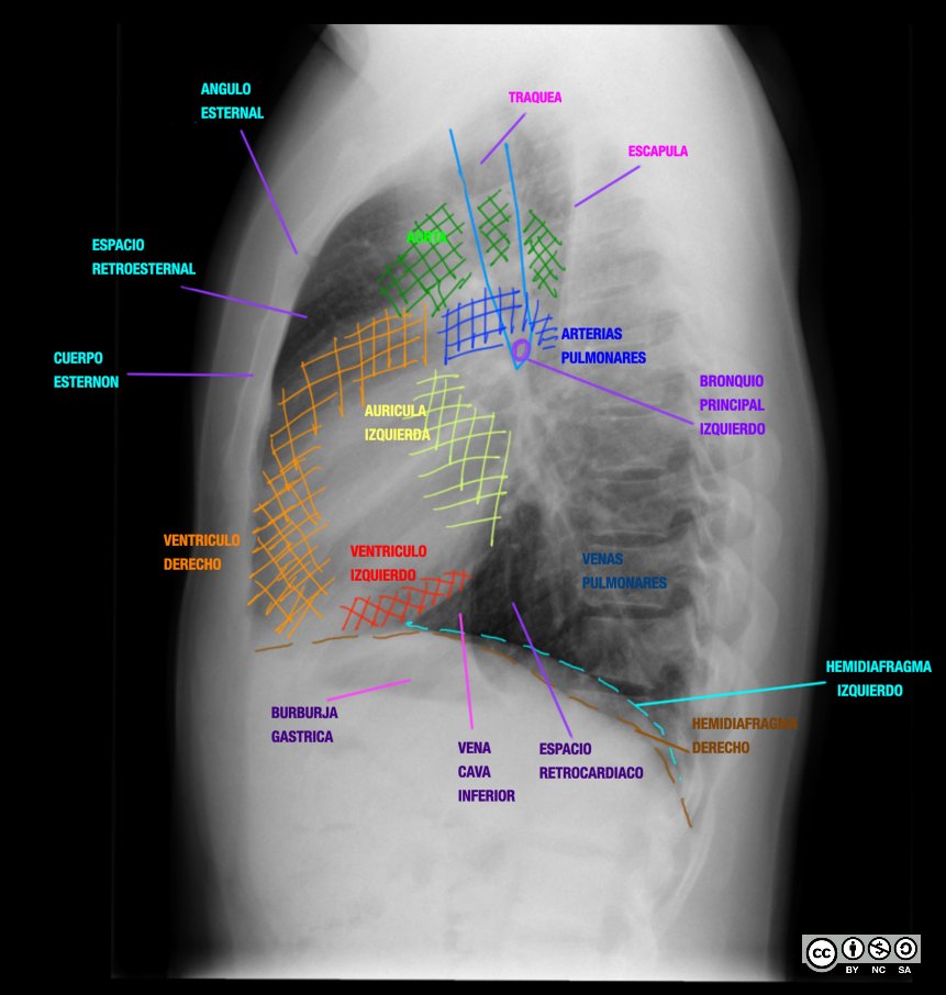 Anatomía De La Radiografía De Tórax Lateral Estructuras Básicas En
