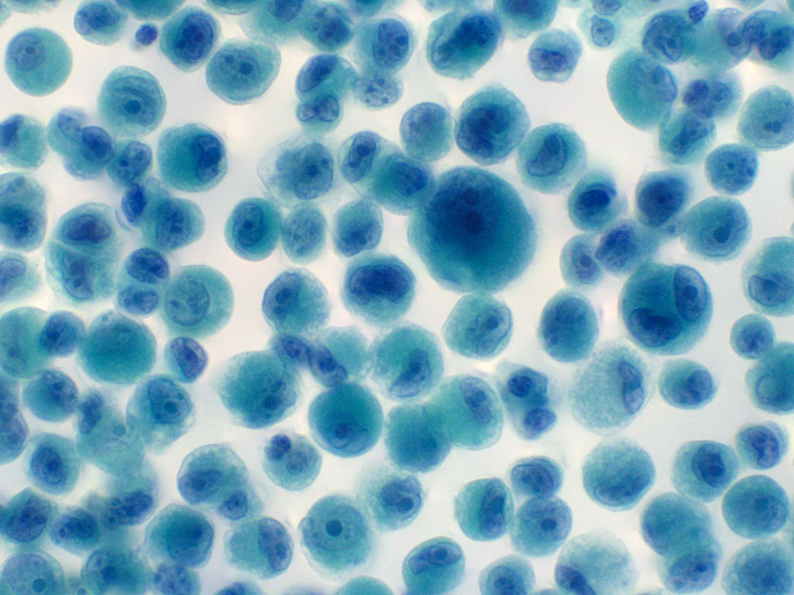 Hepatocellular Carcinoma Cytology