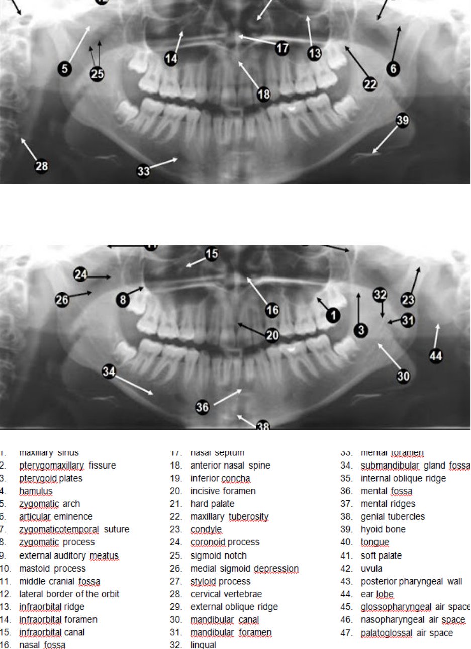 Inferior Nasal Concha Radiograph