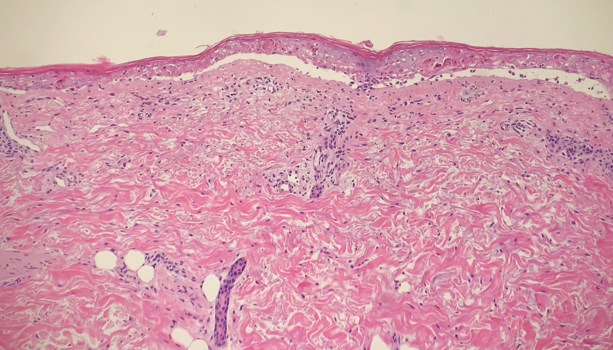 Toxic Epidermal Necrolysis Histology