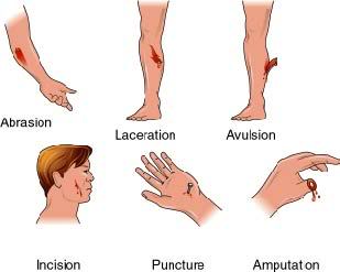 Avulsion Wound Definition