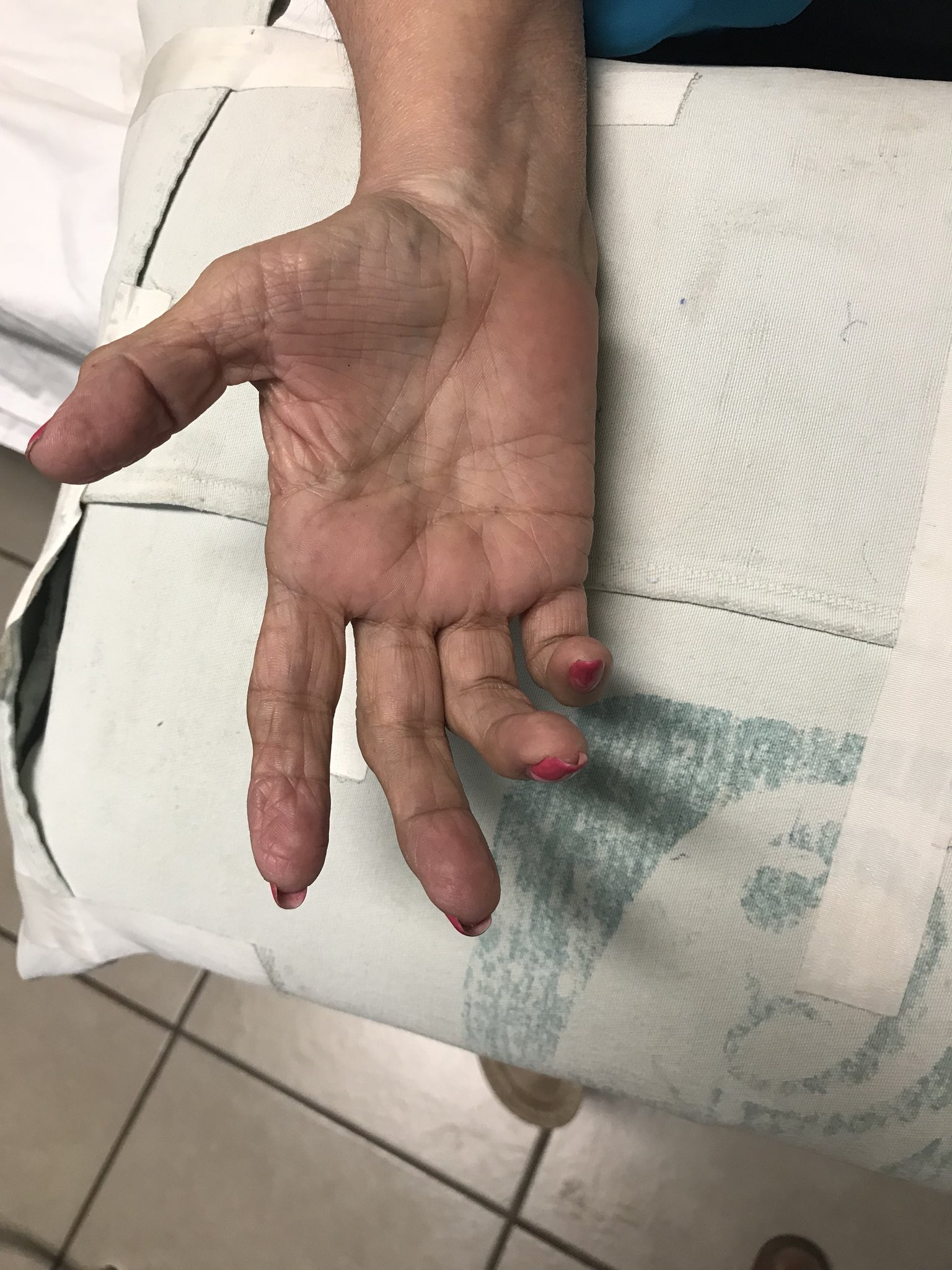 Nervio Cubital Mano En Garra