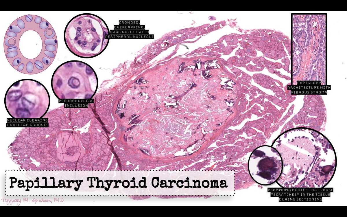 Papillary Carcinoma Thyroid Psammoma Bodies