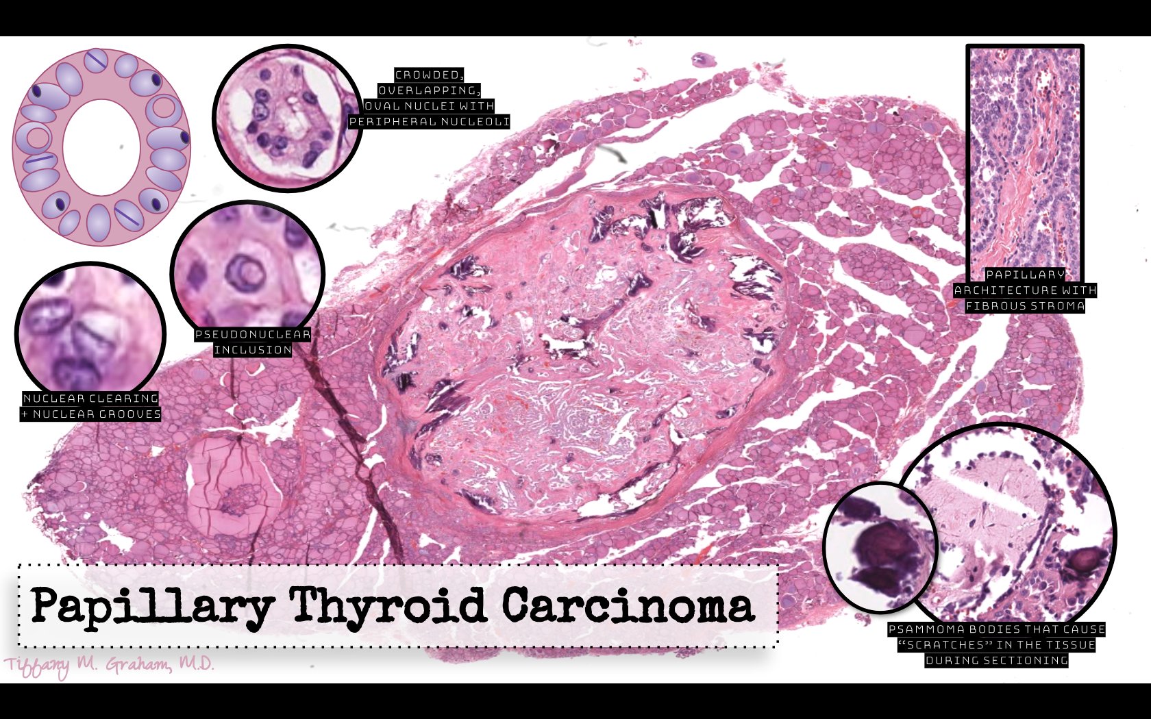Papillary Thyroid Cancer Psammoma Bodies