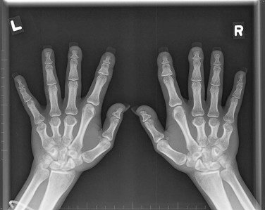 Albright Hereditary Osteodystrophy
