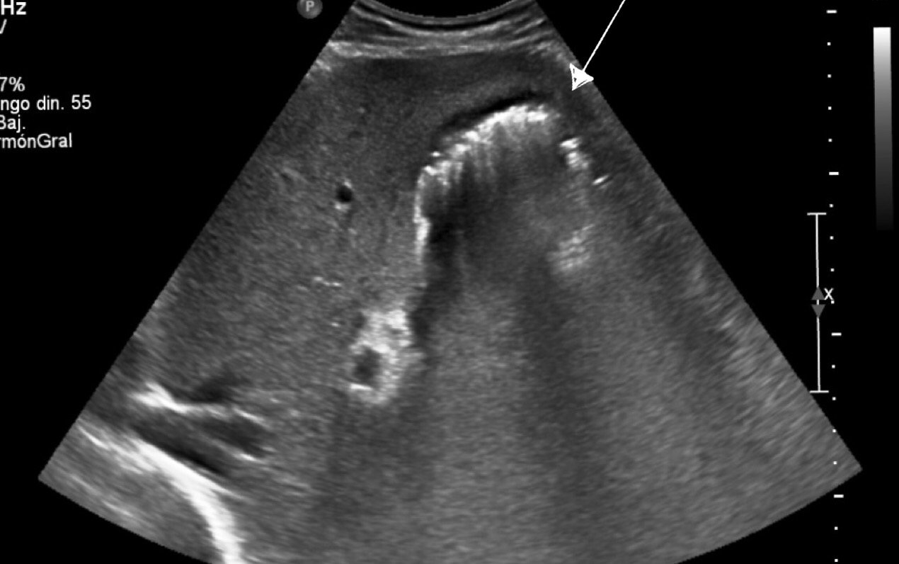 Emphysematous Cholecystitis Ultrasound