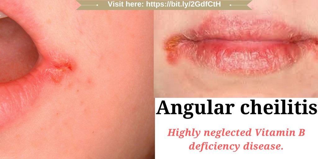 Angular Stomatitis Vs Cold Sore