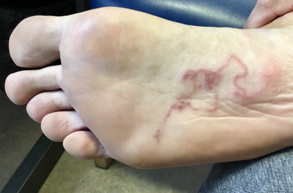 Cutaneous Larva Migrans Hookworm