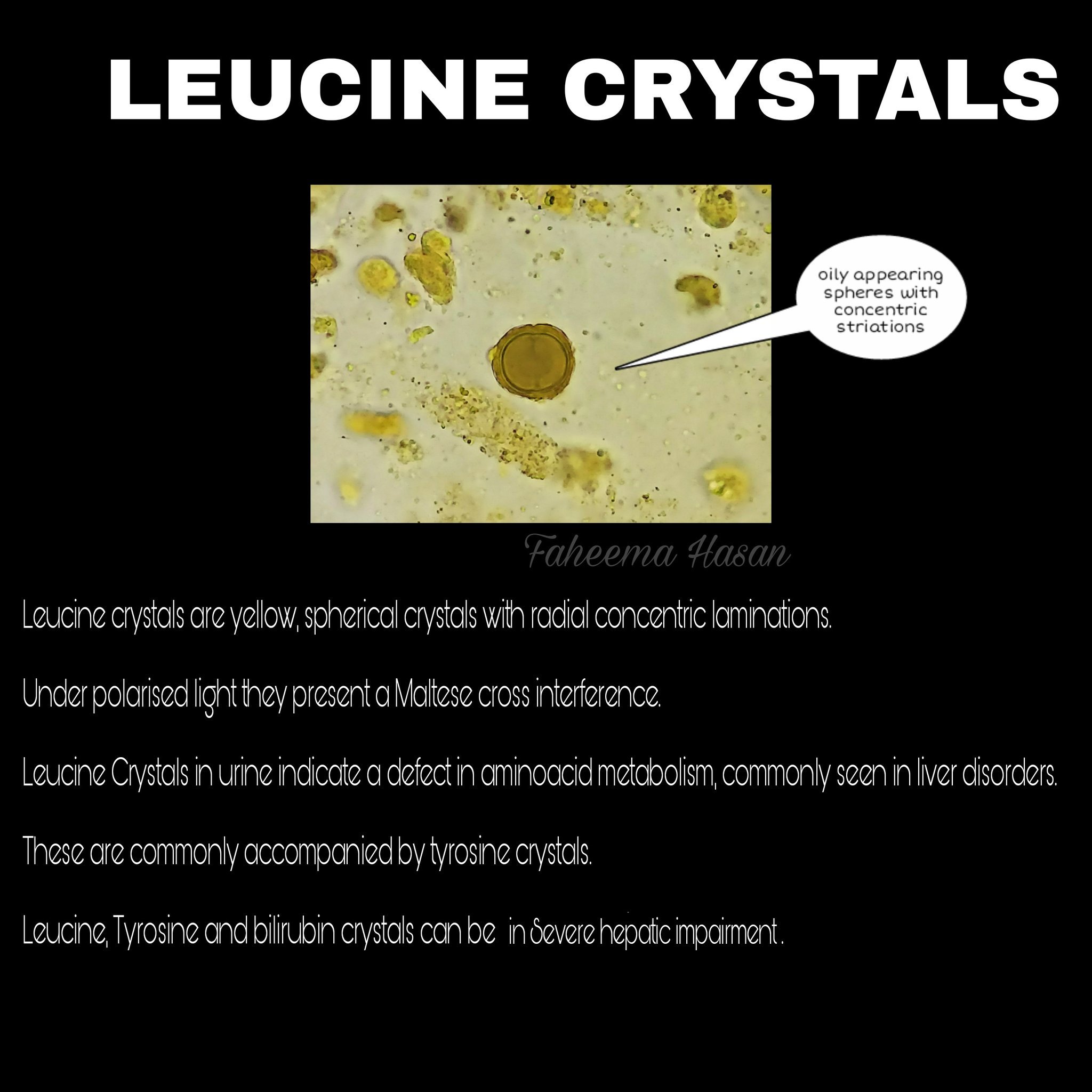 Tyrosine Crystals In Urine