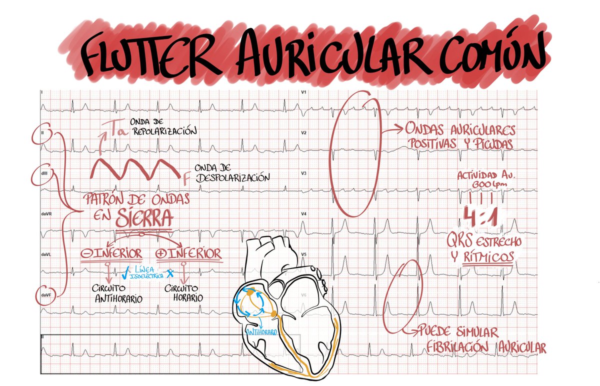 Atrial Flutter Litfl Ecg Library Diagnosis