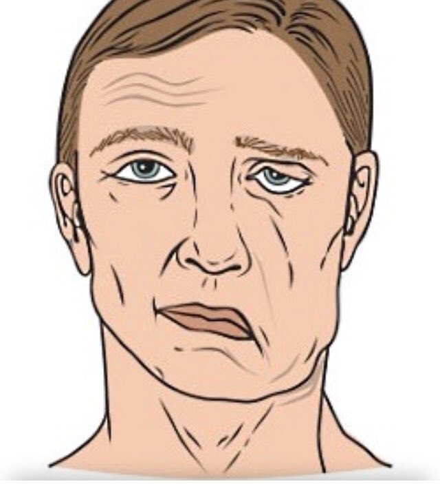 Stroke Face Paralysis