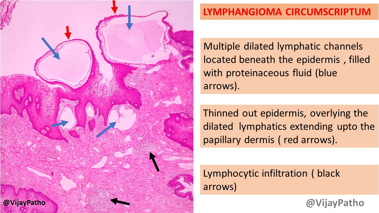 Lymphangioma Circumscriptum