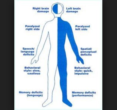 Right Sided Brain Damage