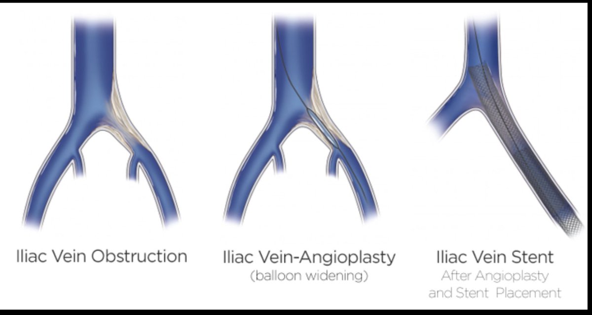 Compression Of Iliac Vein