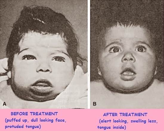 Hypothyroidism Before And After Face