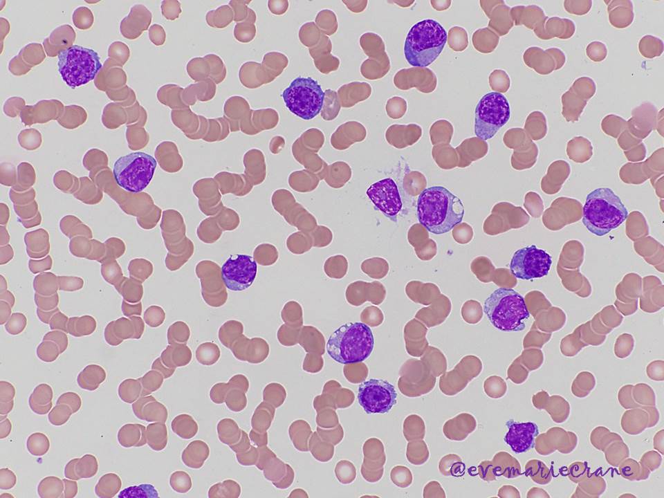 Rouleaux Cells Autoagglutination Vs Rouleaux Formation | Medical