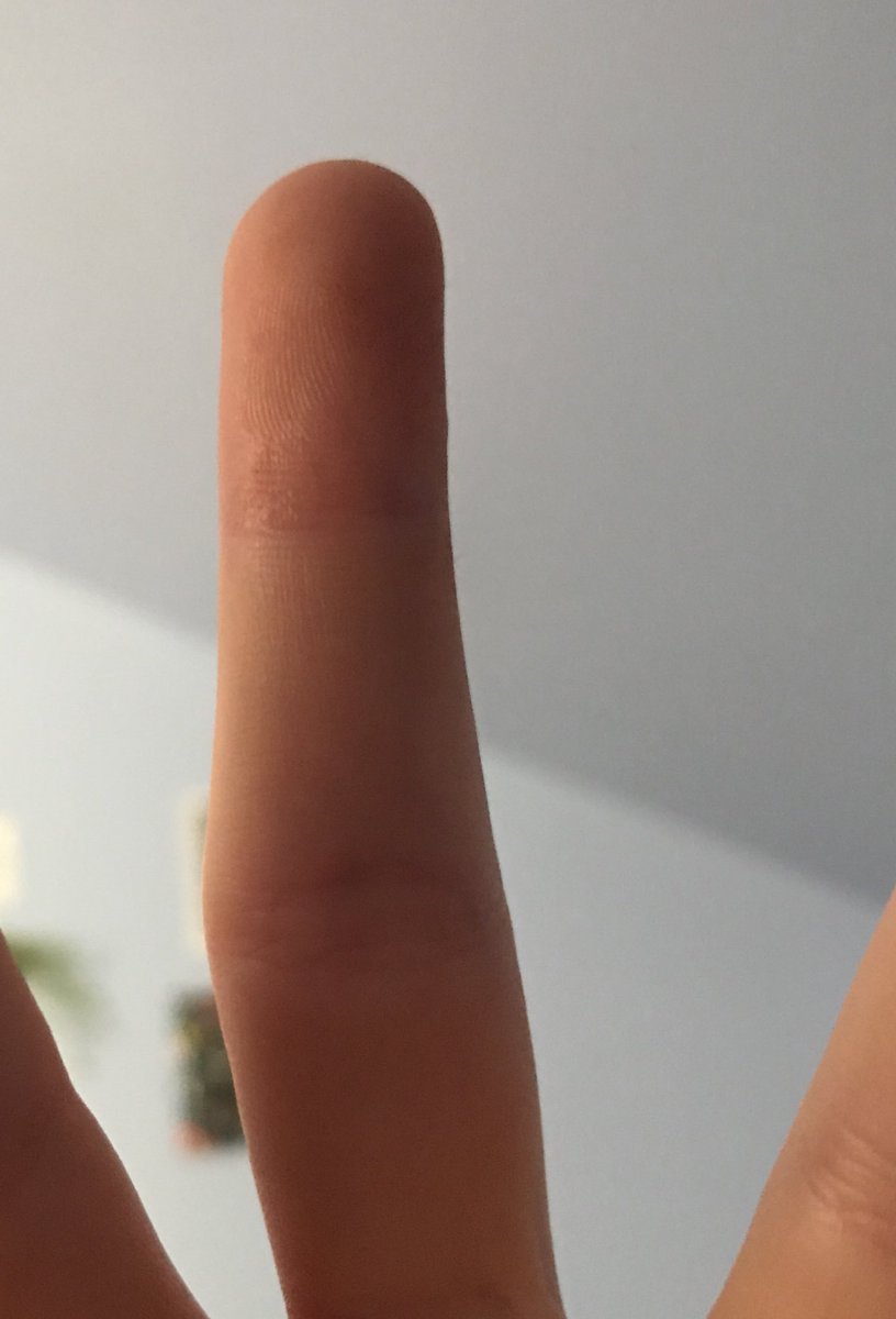 Smashed Middle Finger