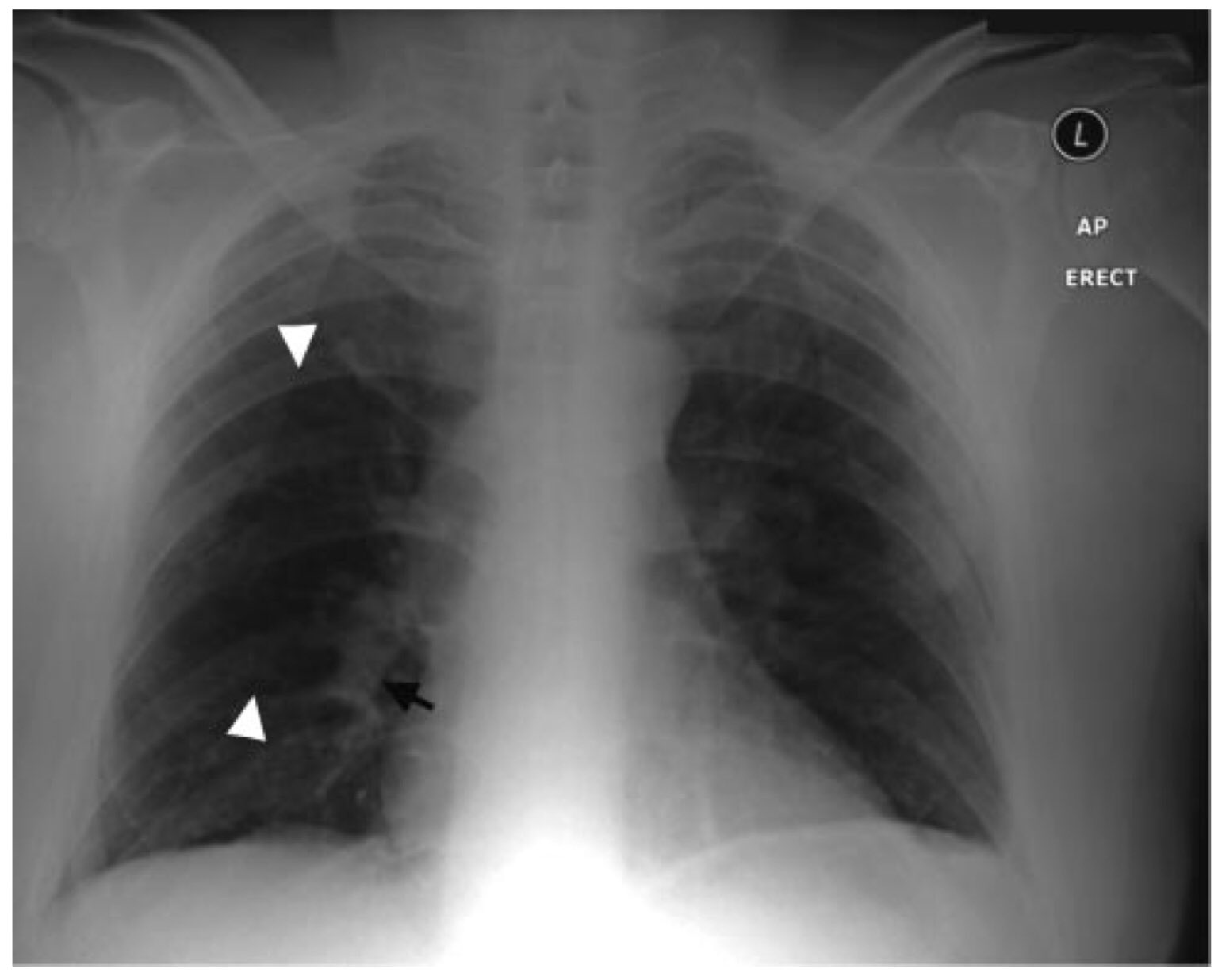 Edgar V Lerma 🇵🇭 On Twitter Pulmonary Embolism Pe On Cxr Signs