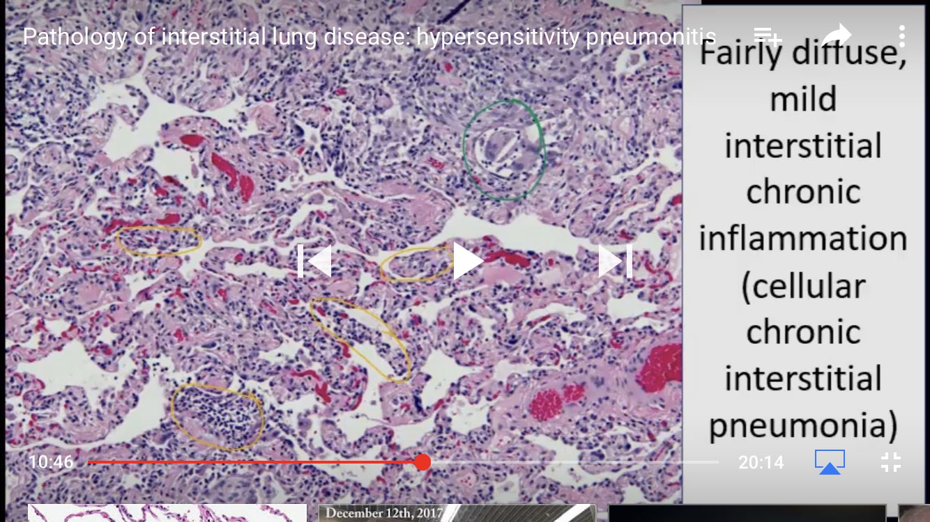 Interstitial Pneumonia Histology