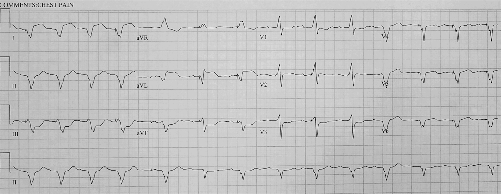 Ventricular Paced Rhythm