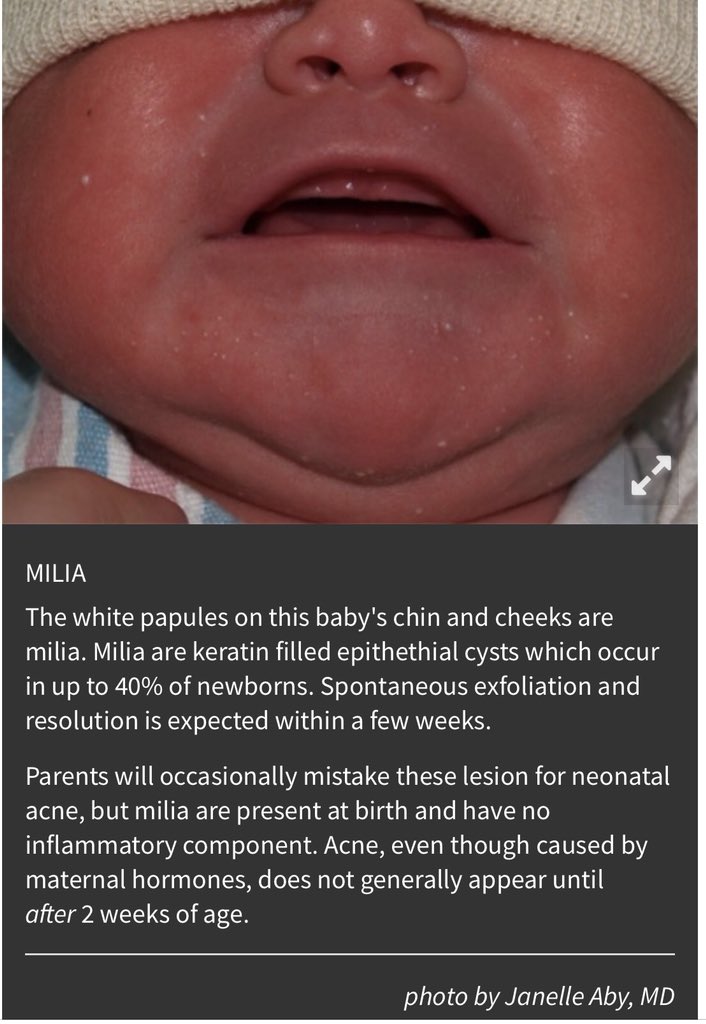 Sebaceous Hyperplasia Newborn
