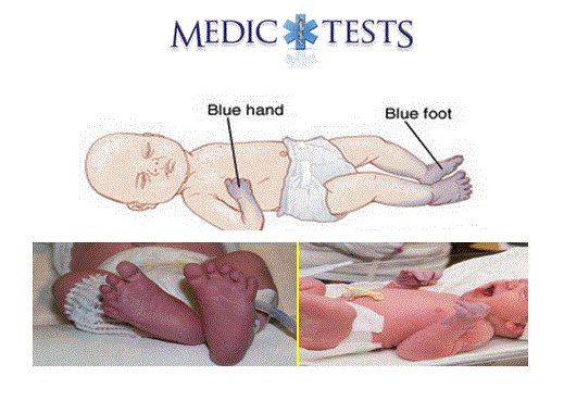 Acrocyanosis Infant