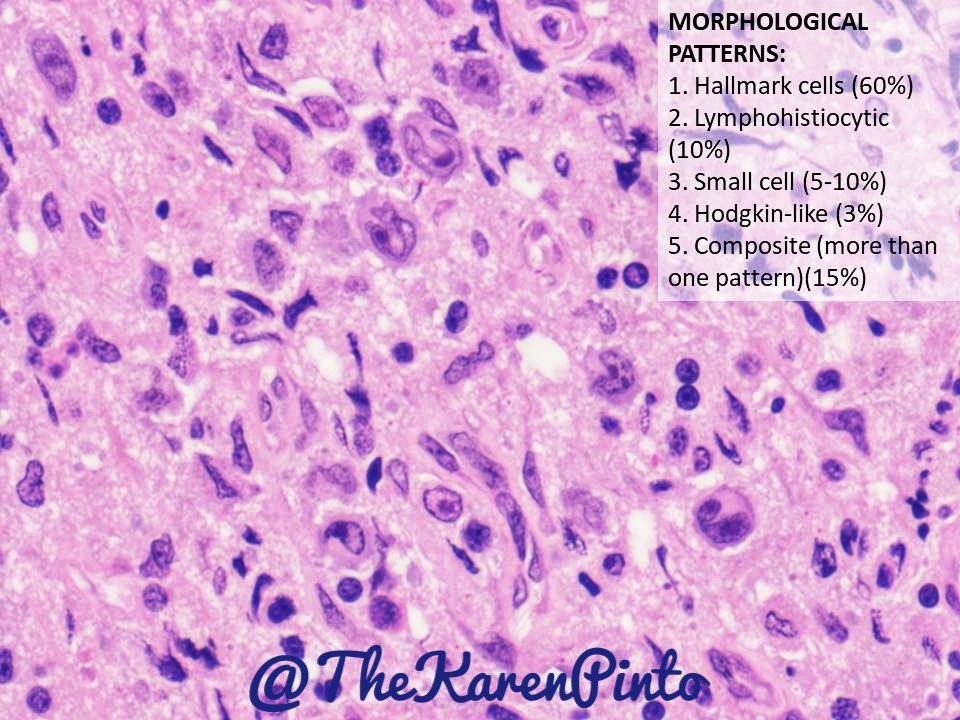 Anaplastic Large Cell Lymphoma Hallmark Cell