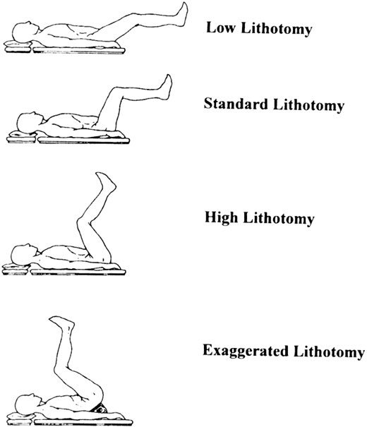 Lithotomy