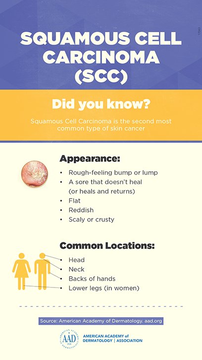 Squamous Cell Carcinoma On Leg