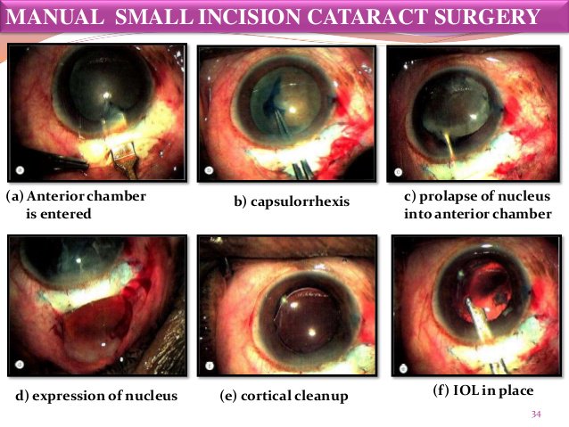 Extracapsular Cataract Extraction Illustration