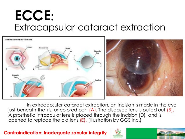 Extracapsular Cataract Extraction Illustration