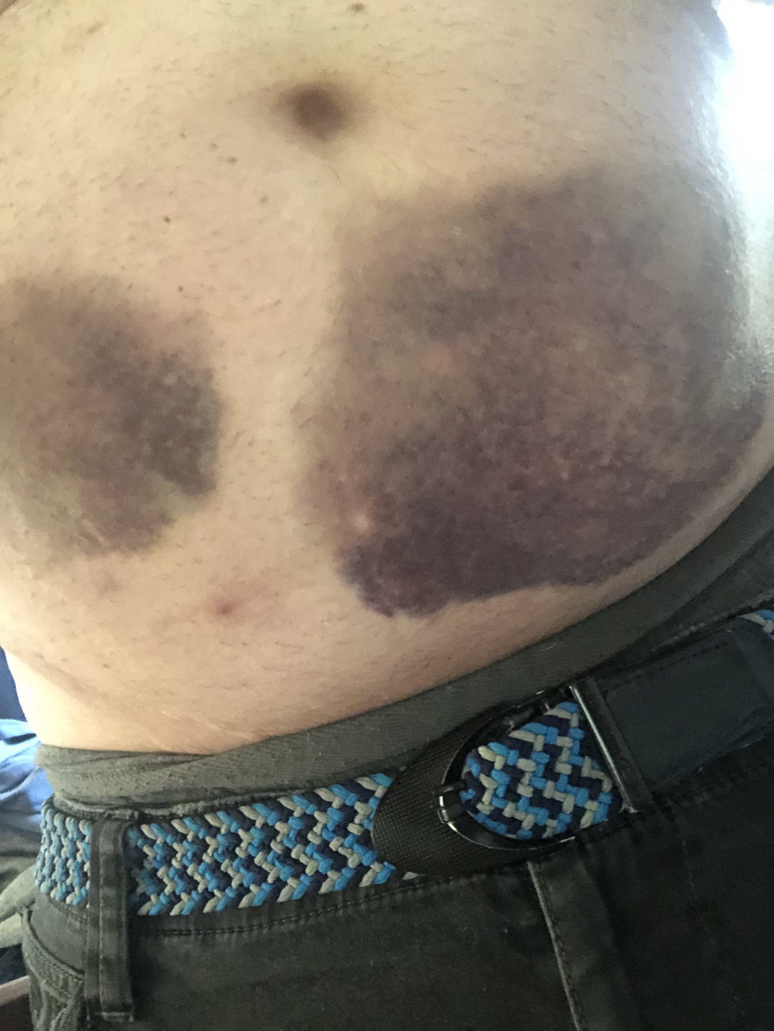 Lovenox Bruises