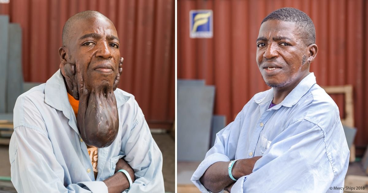 Biggest Tumor In The World