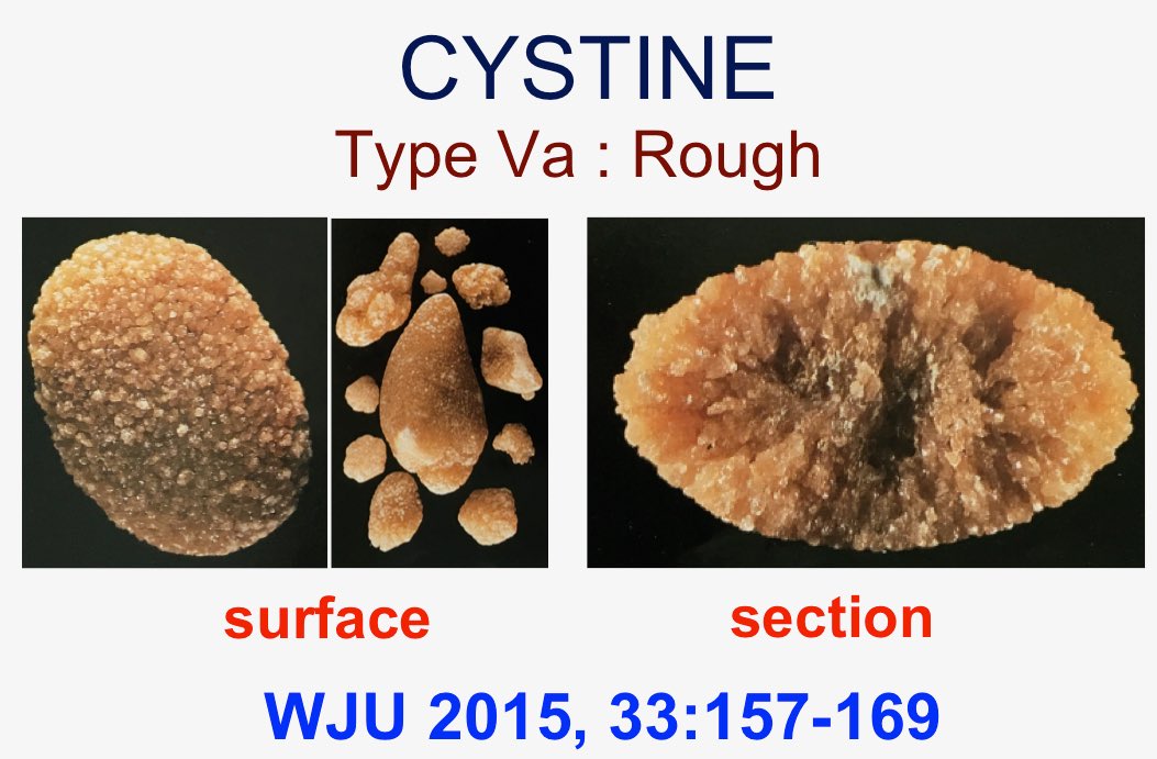Cystine Stones