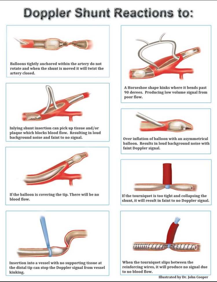 Carotid Endarterectomy Shunt