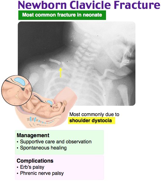 Shoulder Dystocia Xray