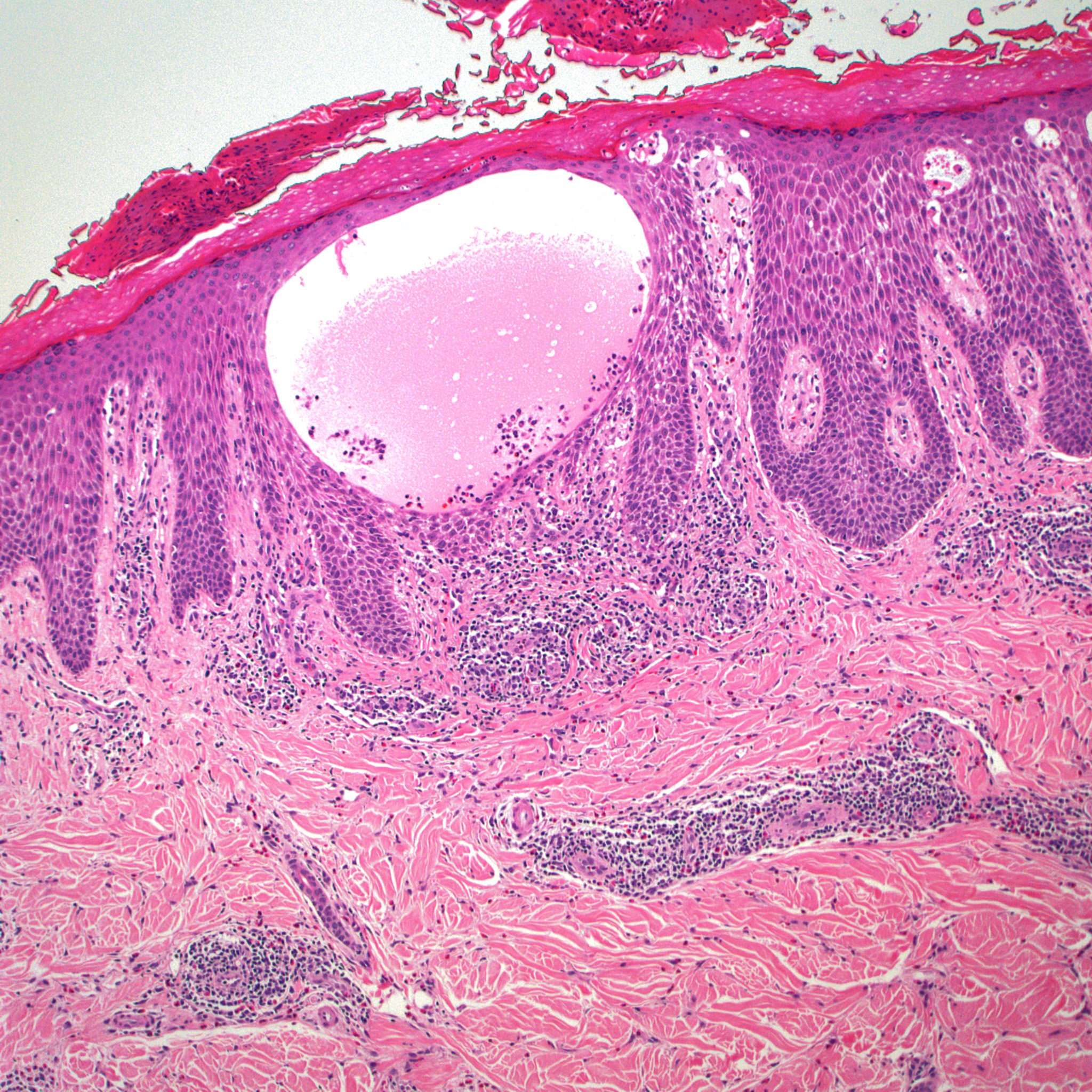 Eczematous Dermatitis Histopathology