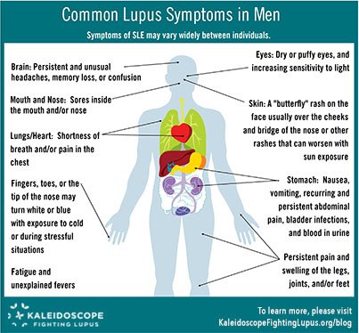 Diagnosing Lupus In Men