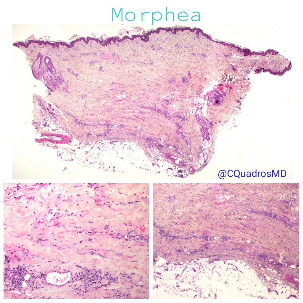 Morphea Histopathology