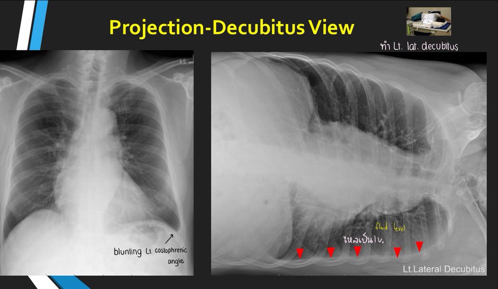 Decubitus Chest X Ray Pleural Effusion at Vicki Houde blog