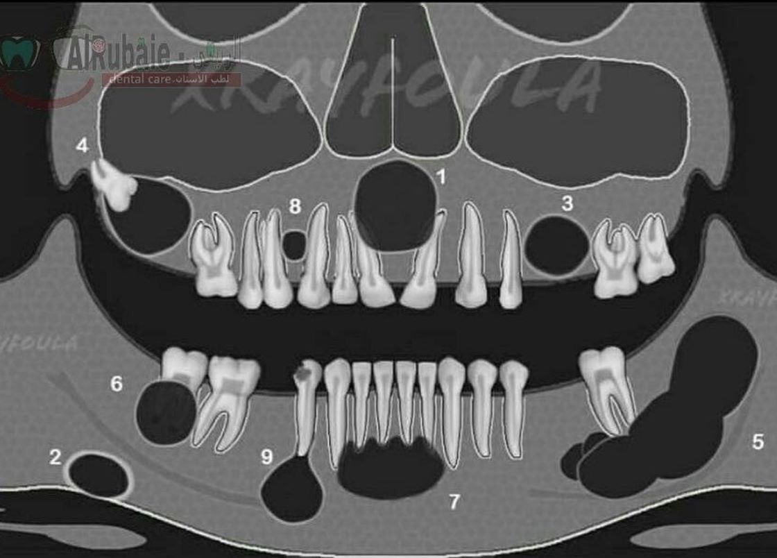 Globulomaxillary Cyst
