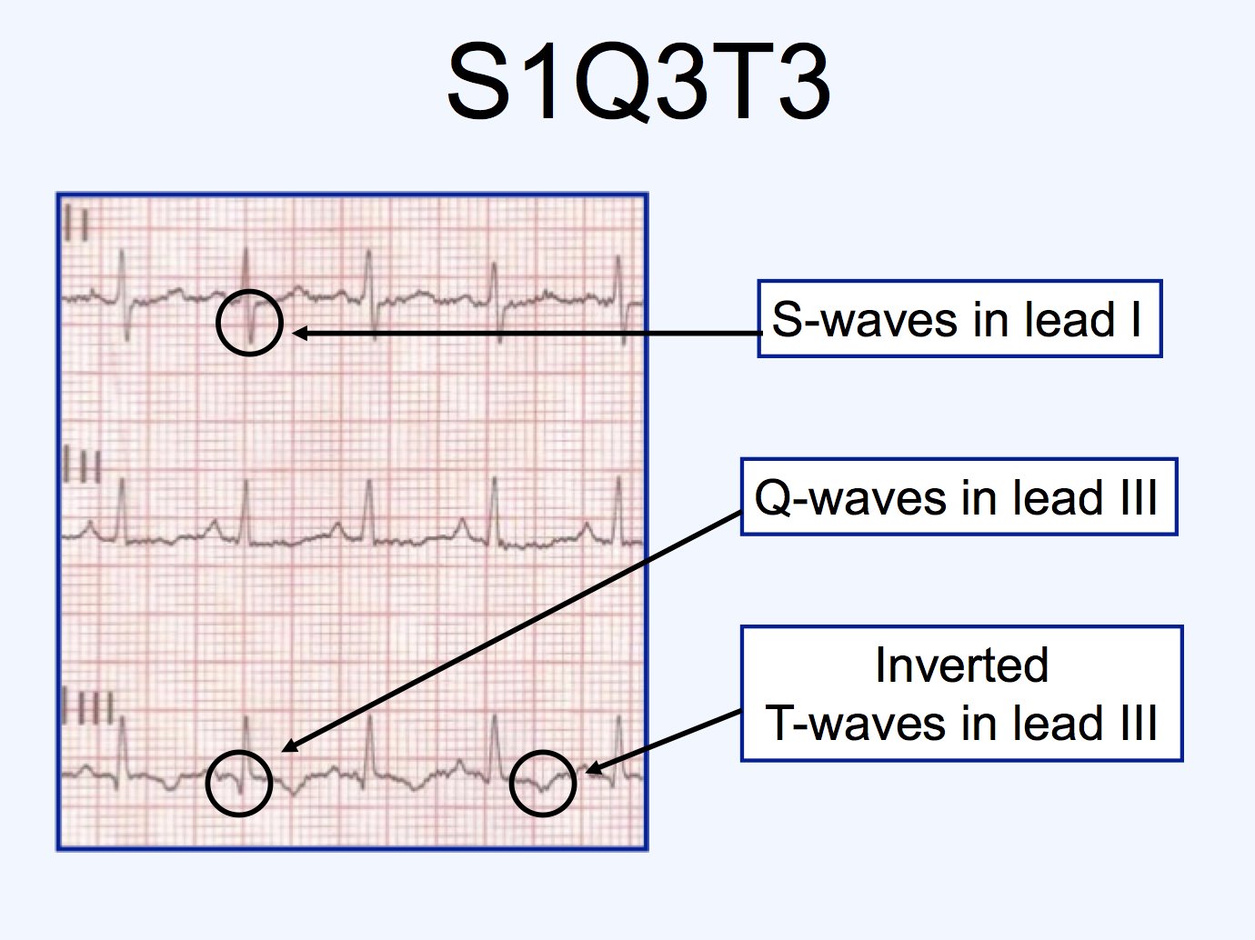 Pulmonary Embolism Ecg