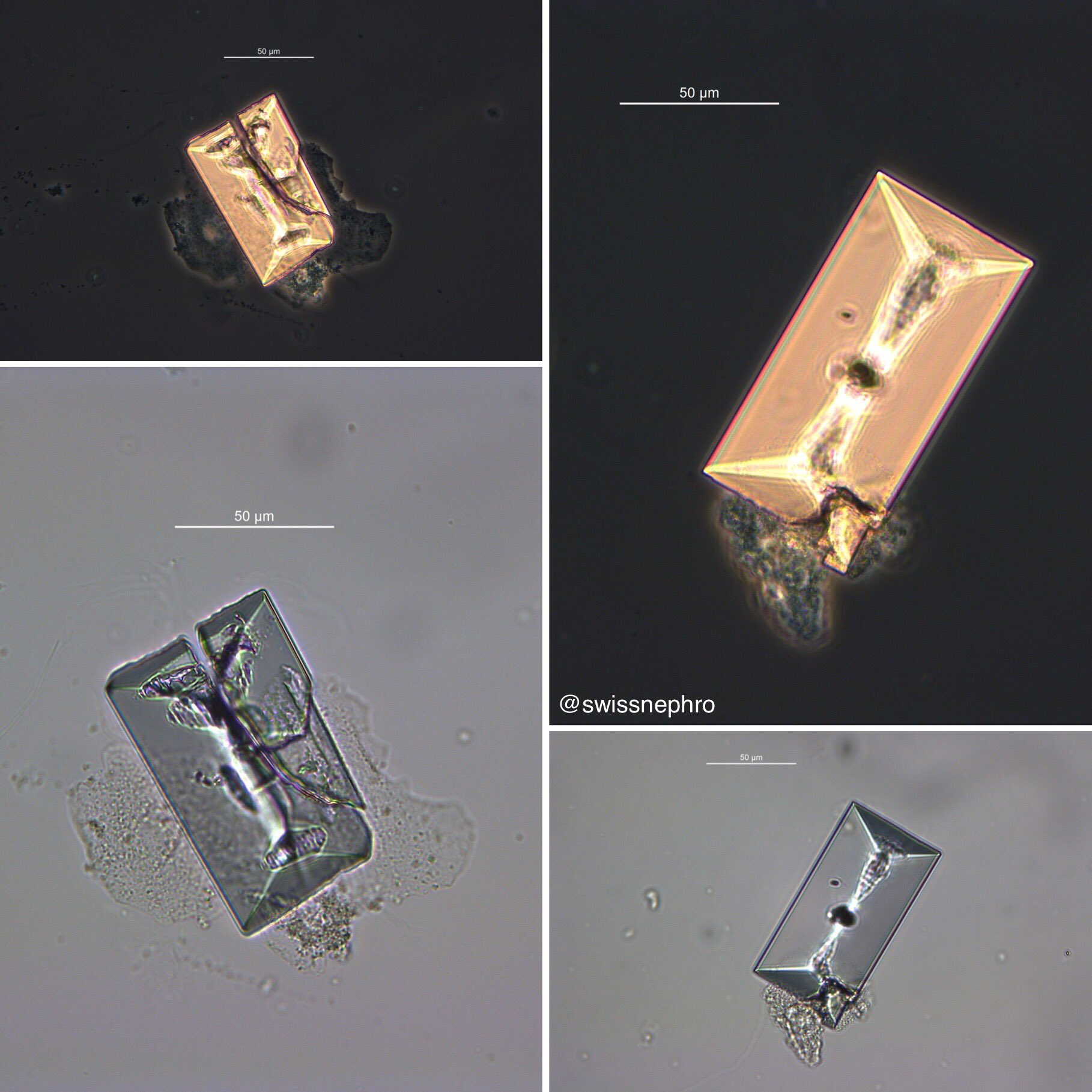 Triple Phosphate Crystals In Urine