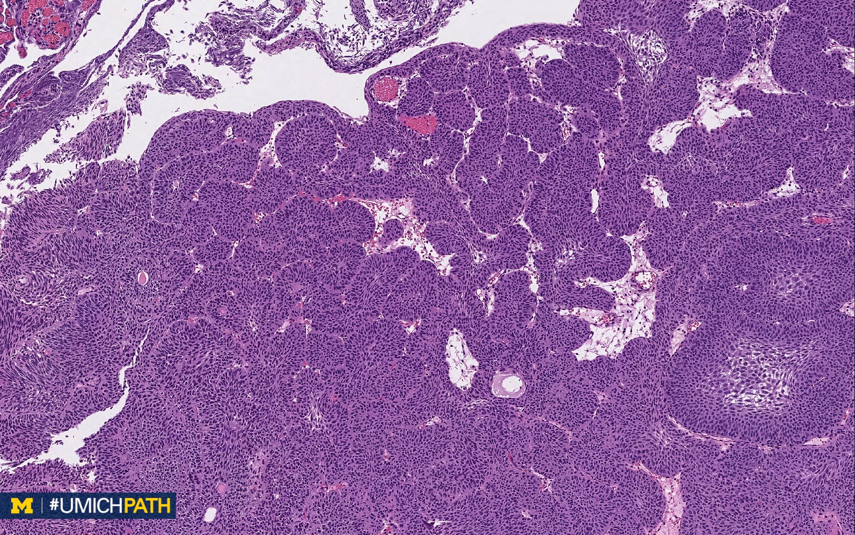 Inverted Papilloma Bladder