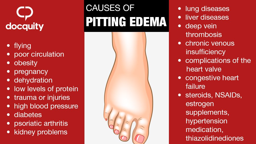 Pitting Edema Symptoms Causes And When To See A Docto - vrogue.co Pitting Edema Symptoms Causes And When To See A Docto - vrogue.co