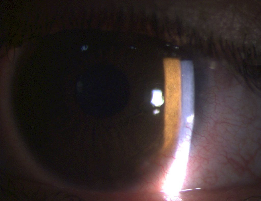 Staphylococcal Marginal Keratitis