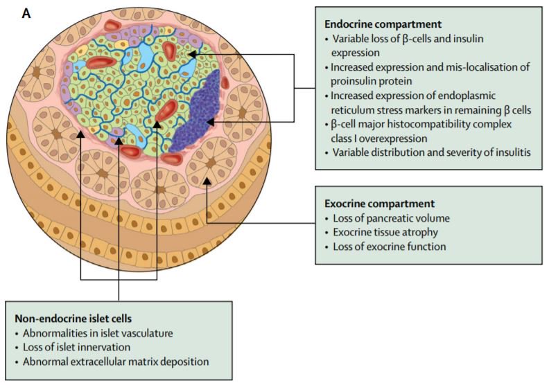 Pancreas Diabetes Diagram