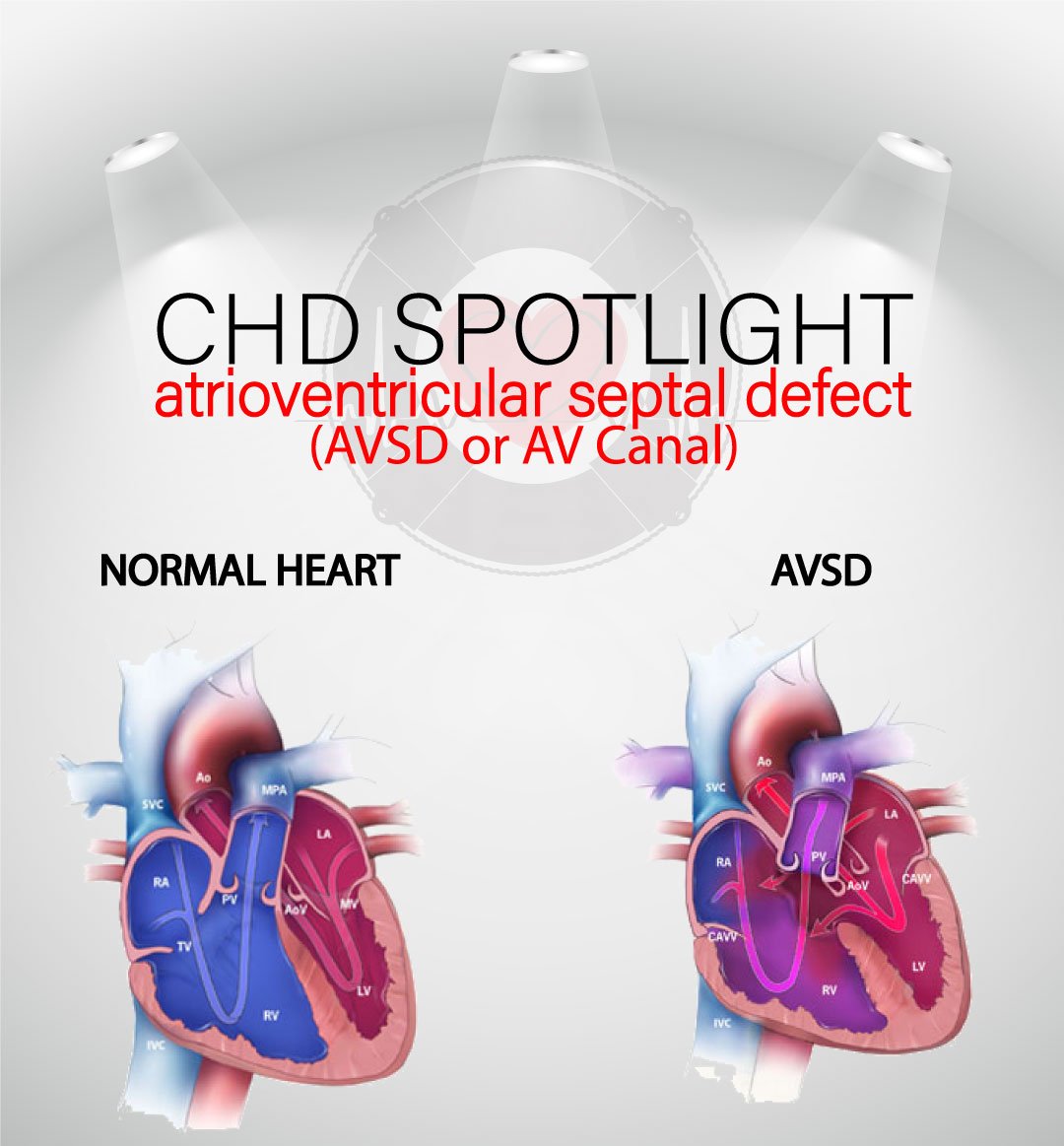 Atrioventricular Septal Defect